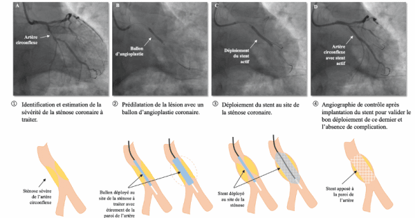 Comment se déroule la pose d'un stent ? - CM 35
